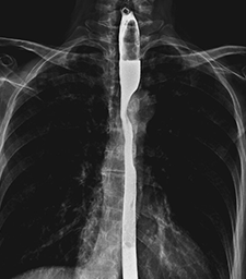Transit oeso-gastro-duodénal (TOGD) | Centre d'imagerie Médicale RISF