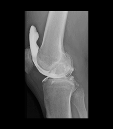 infiltration du genou | Centre d'imagerie Médicale RISF